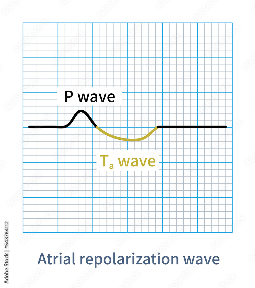 On ECG, is a low amplitude wave generated by atrial repolarization, and ...