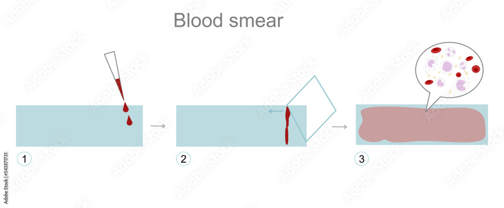 The step of blood smear or film of blood cell observation on glass ...