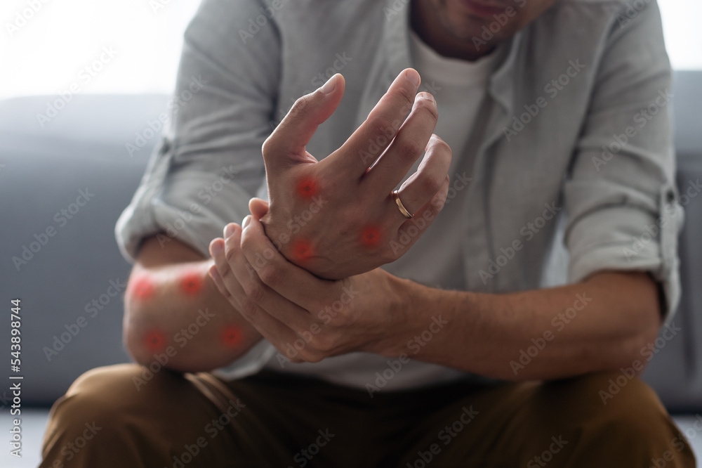 ill allergic rash dermatitis eczema skin of patient Stock Photo | Adobe ...