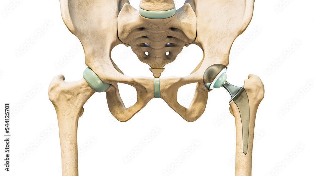 Hip prosthesis or implant isolated on white background. Hip joint or ...