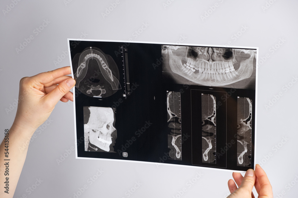 The doctor holds a CT scan of a patient with temporomandibular joint ...