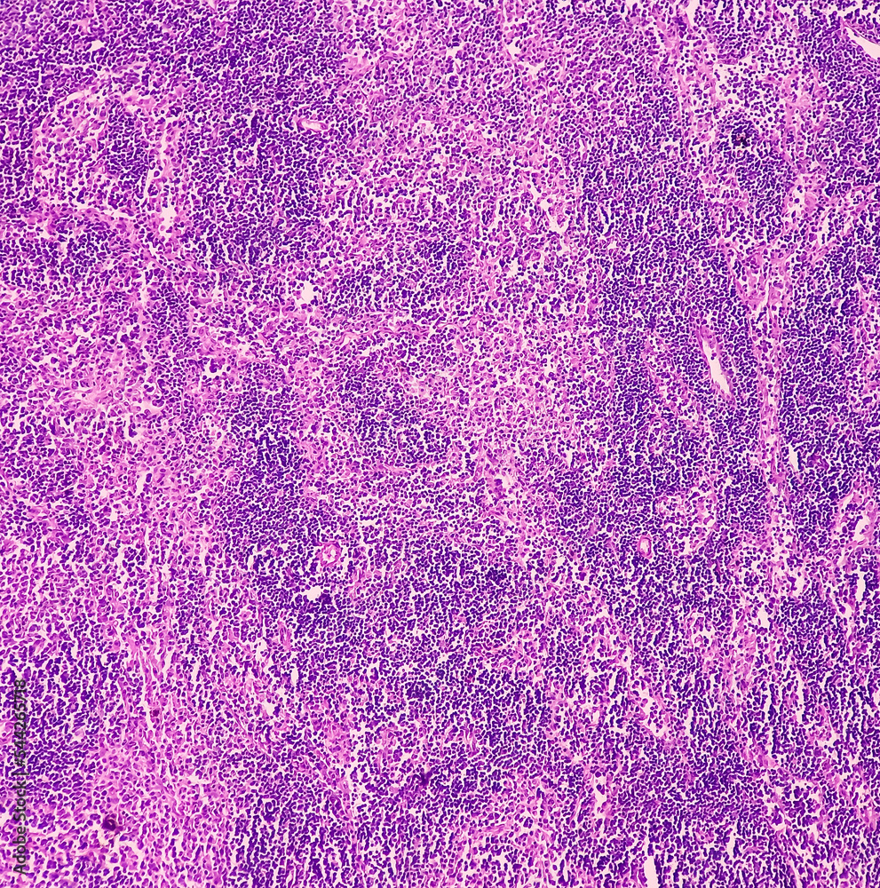 Caecum lymph node biopsy: Chronic nonspecific lymphadenitis ...