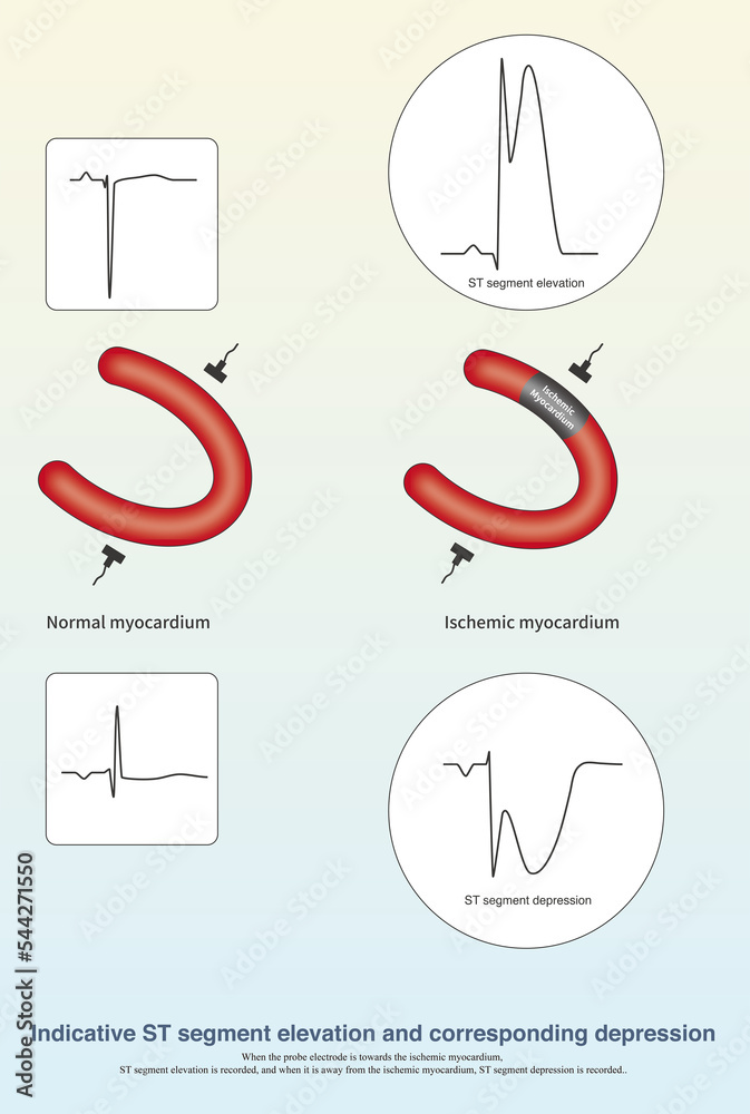 When acute transmural myocardial ischemia occurs, the ST segment of the ...