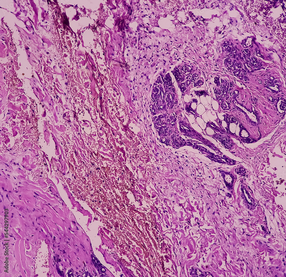 Prepatellar region histology: Chronic bursitis. light microscopic image ...