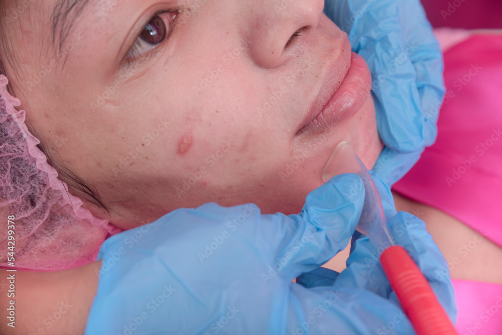 Using a pore vacuum to clean and unclog pores on the chin of a customer ...