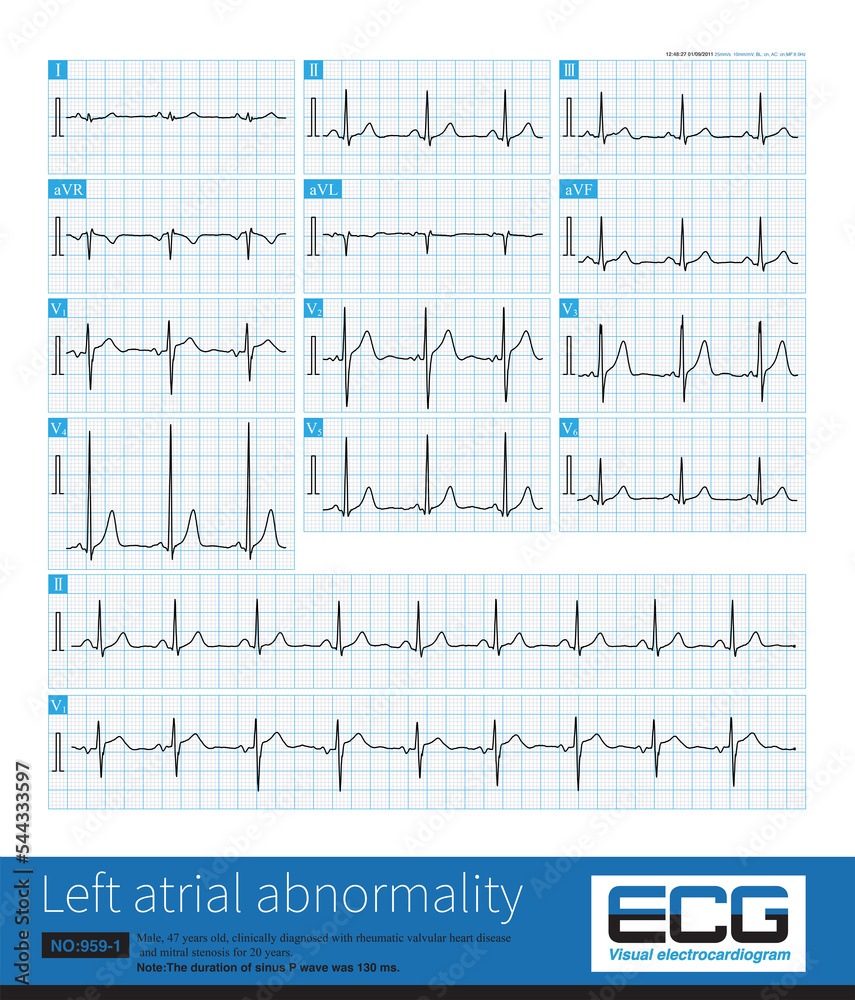 In clinic, mitral stenosis is a common organic heart disease that leads ...