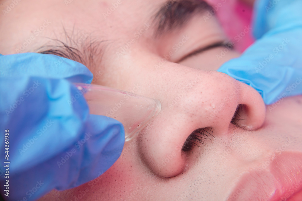 Using a pore vacuum to clean and unclog pores on the nose area of a ...