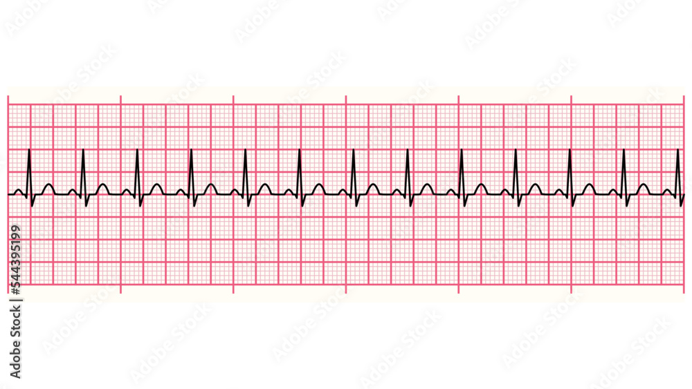 ECG Sinus Tachycardia - 8 Second ECG Paper Stock Vector | Adobe Stock