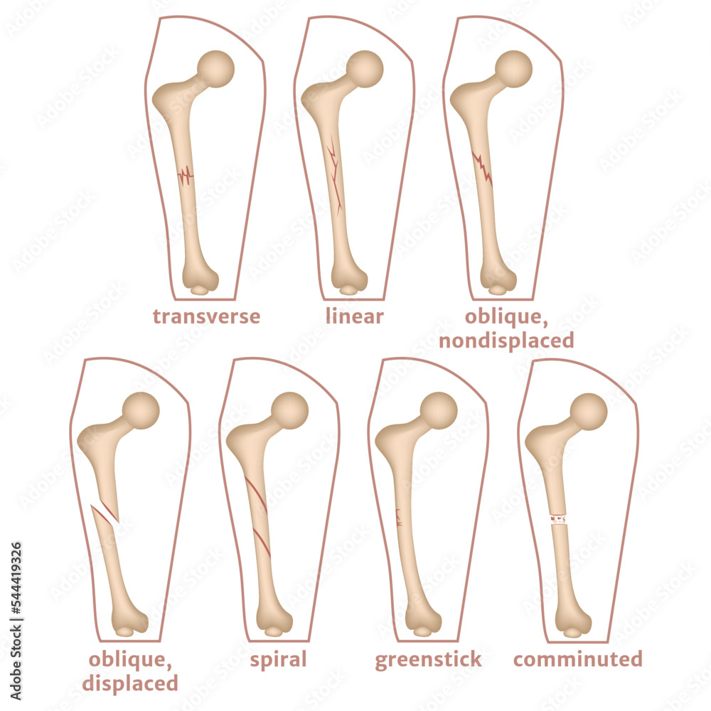 Infographic with types of fractures of the human femur. Medical poster ...
