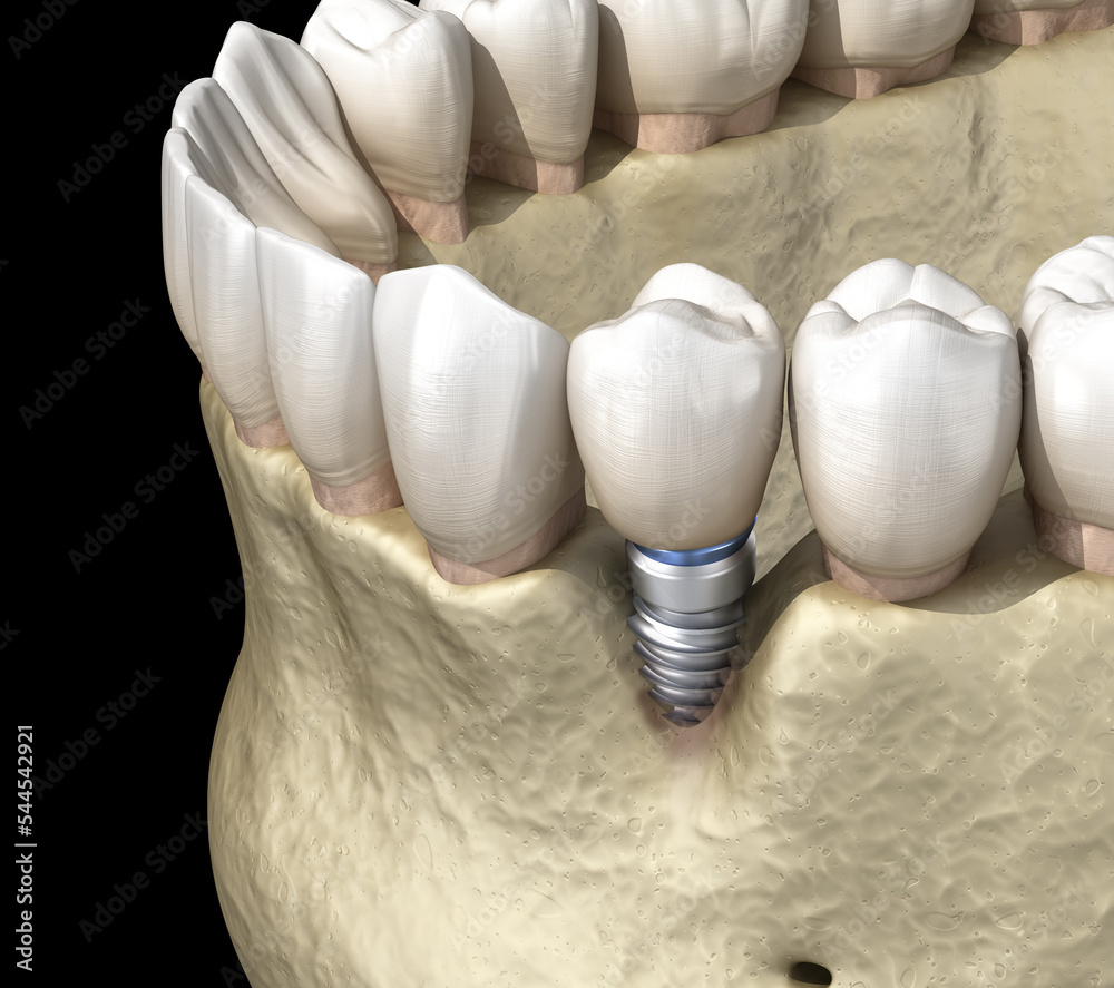 Peri Implantitis With Visible Bone Recession Medically Accurate 3d Illustration Of Dental