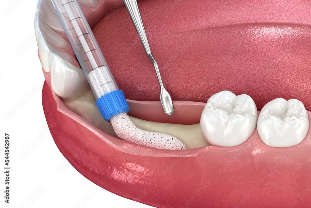 Bone grafting augmentation for tooth implantation. Medically accurate ...