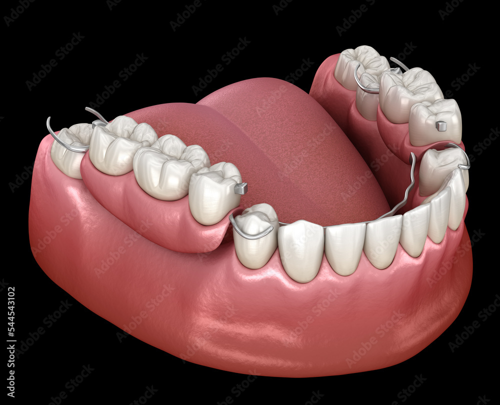 Removable partial denture, mandibular prosthesis. Medically accurate 3D ...