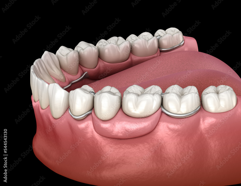Removable partial denture, mandibular prosthesis. Medically accurate 3D ...