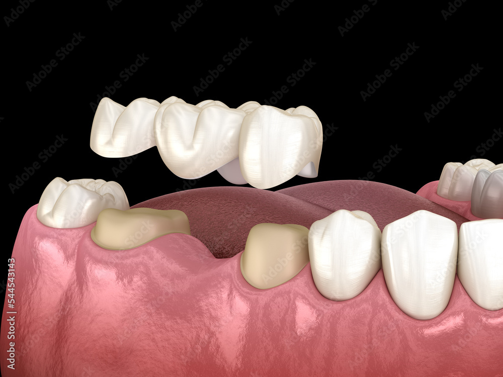 Dental bridge of 3 teeth over molar and premolar. Medically accurate 3D ...