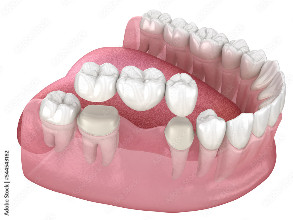 Dental bridge of 3 teeth over molar and premolar. Medically accurate 3D ...