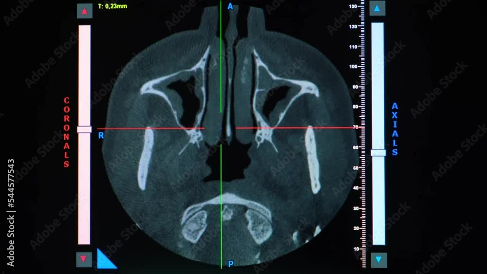 CT scan of a patient with malocclusion, missing tooth and ...