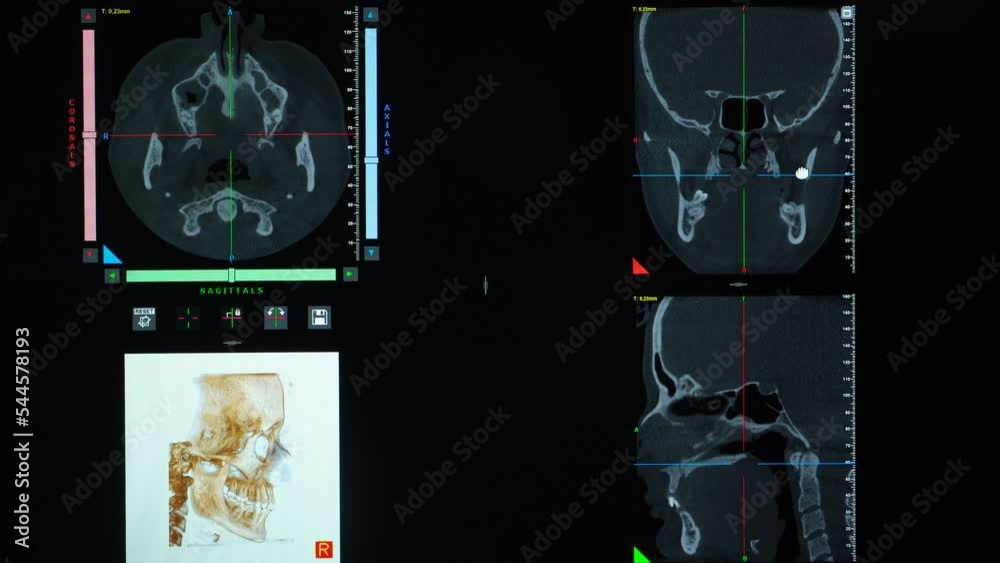 CT scan of a patient with malocclusion, missing tooth and ...