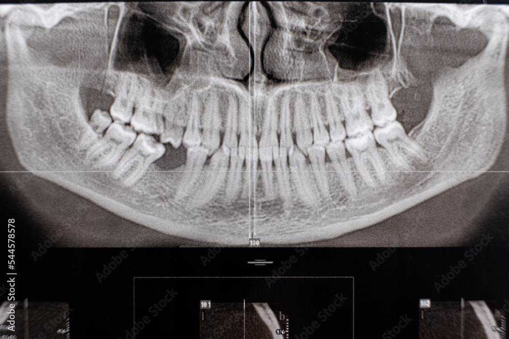 CT scan of a patient with missing chewing tooth and malocclusion Stock ...