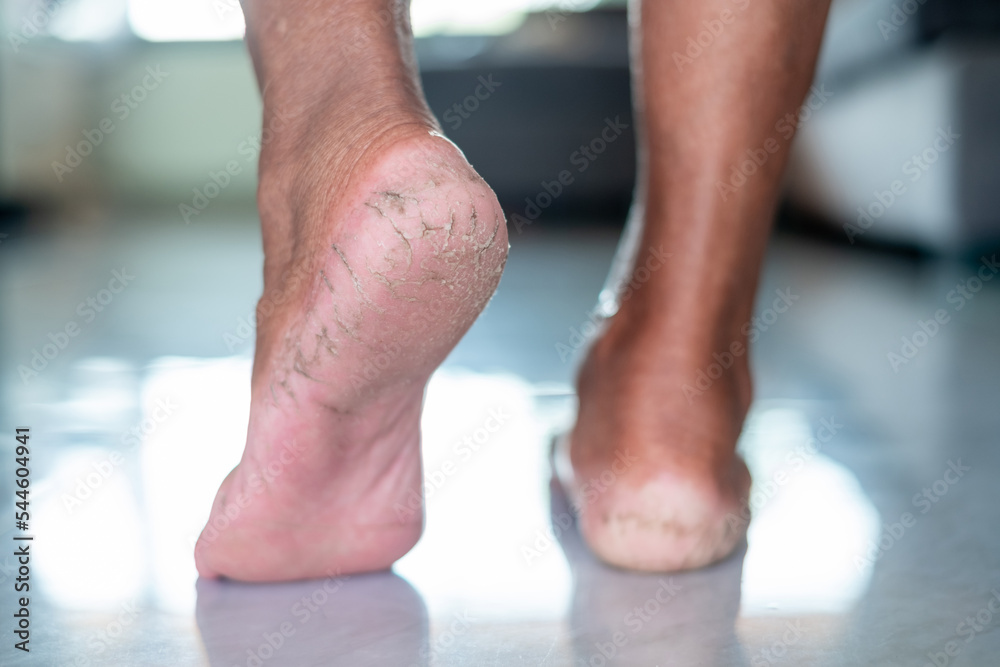 cracked feet, dry skin, close up asia senior woman cracked feet,The ...