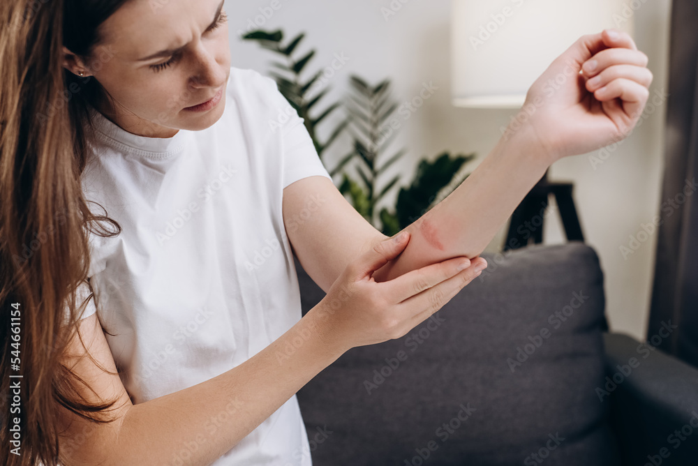 Unhealthy sad young brunette female sitting on couch have skin problems ...