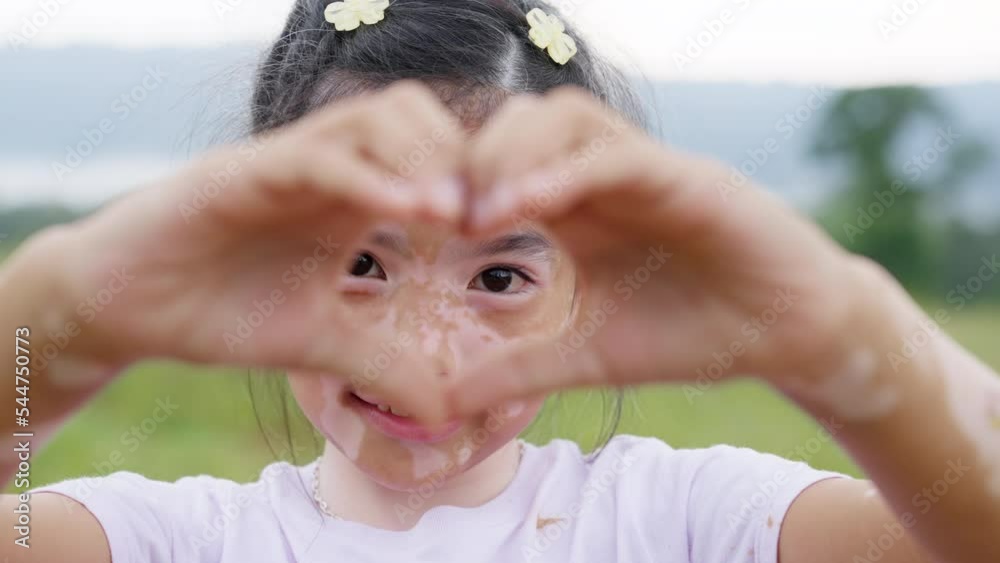Little cute alpha young albino vitiligo small girl relax smile give ...