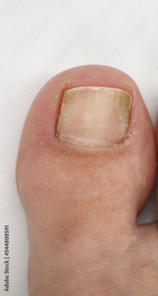 Big toe nail of a person suffering from onychomycosis a fungal ...
