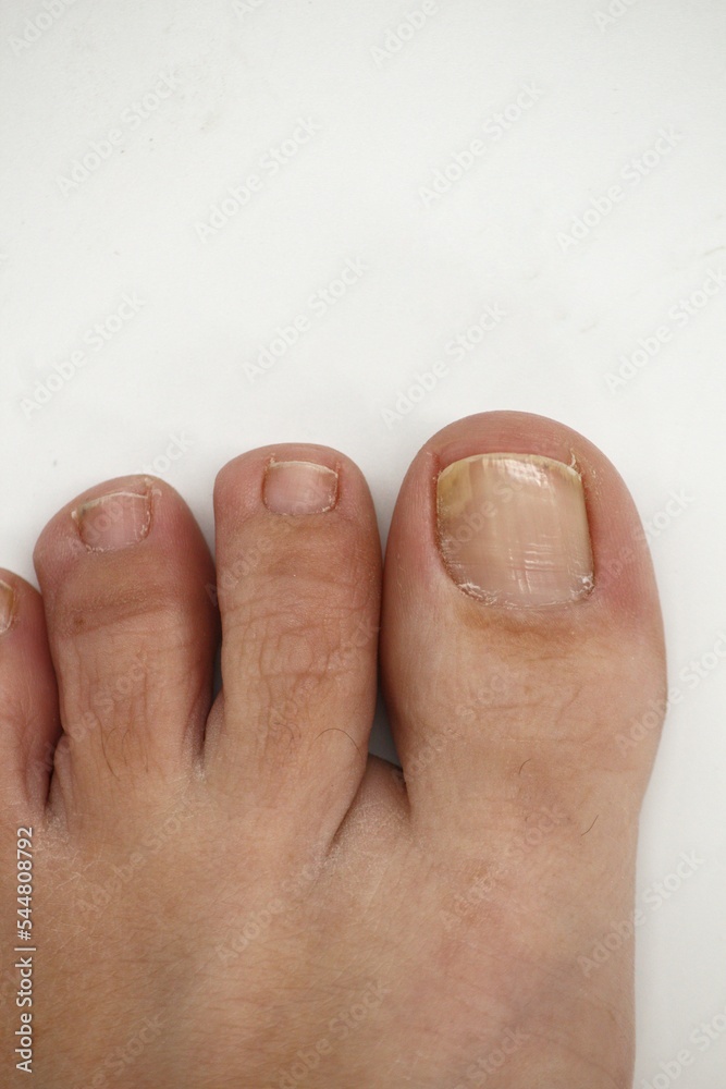 Big toe nail of a person suffering from onychomycosis a fungal ...