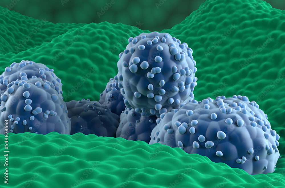 Prostate cancer cells in the prostatic glandular epithelium - closeup ...