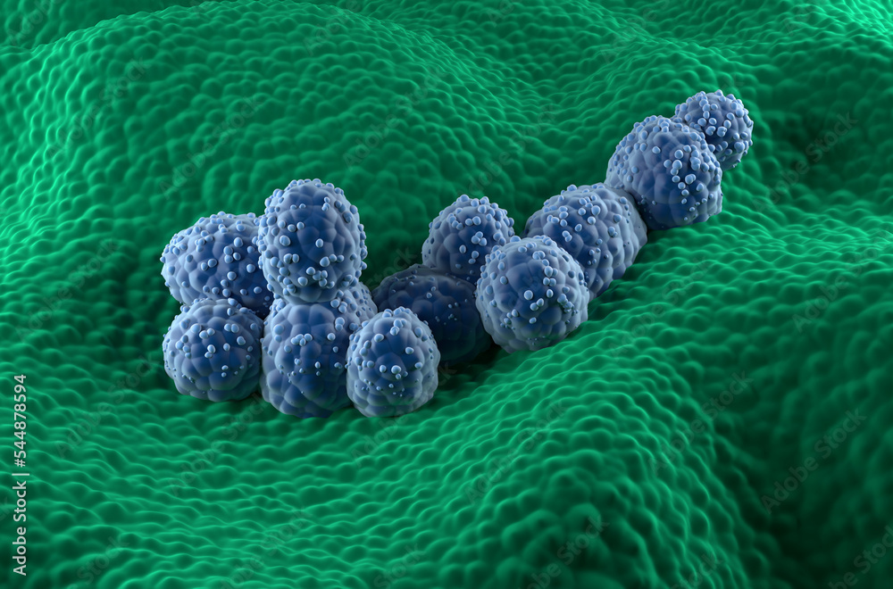 Prostate cancer cells in the prostatic glandular epithelium - isometric view 3d illustration ...