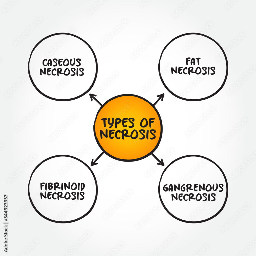 Types of Necrosis (death of body tissue) mind map text concept for ...