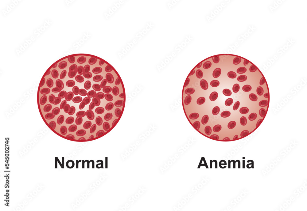 Scientific Designing of Anemia Symptoms. Normal and Anemia Blood ...