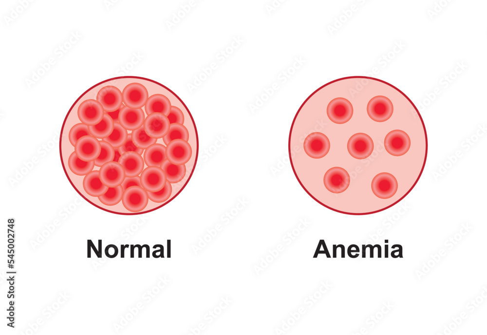Scientific Designing of Anemia Symptoms. Normal and Anemia Blood ...