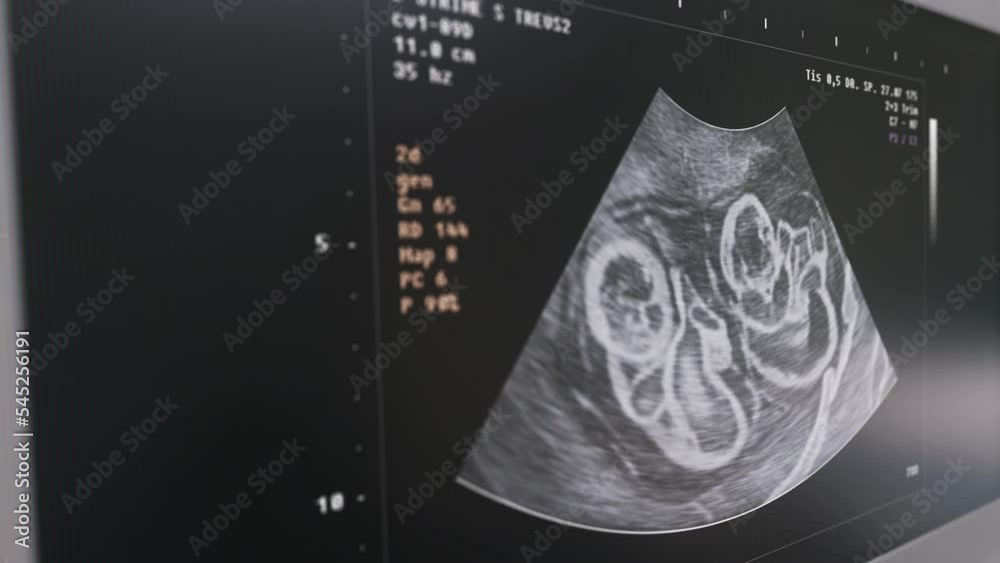 Scanner demonstrates two babies in the womans belly. Prenatal ...