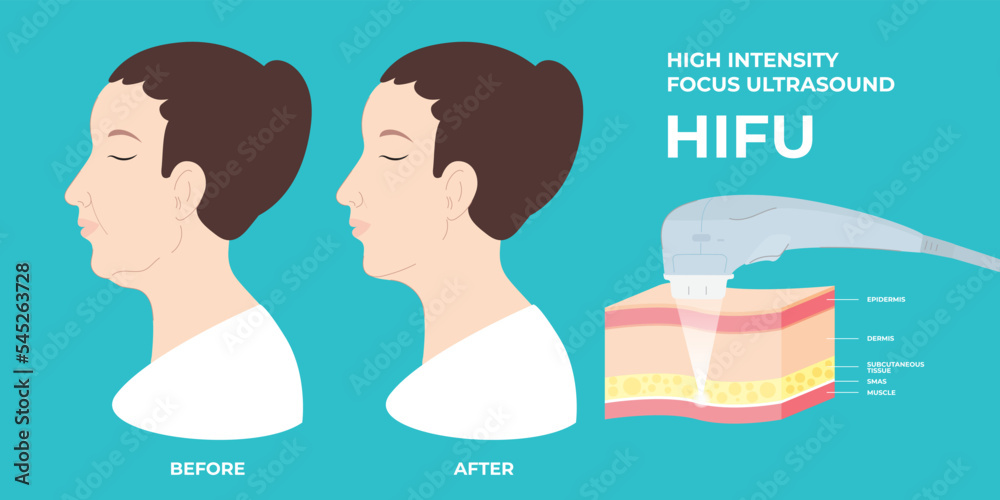 HIFU spa treatment before and after. High intensity focus ultrasound ...