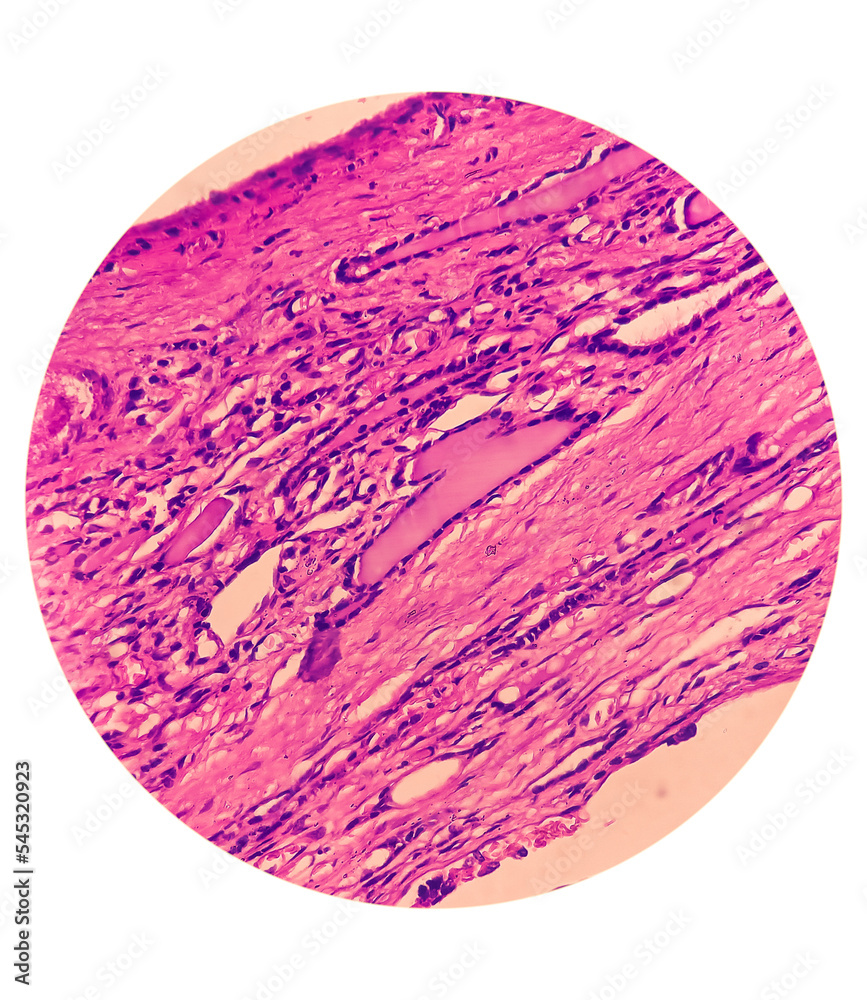 Thyroid cancer: Microscopic image of Follicular variant of papillary ...