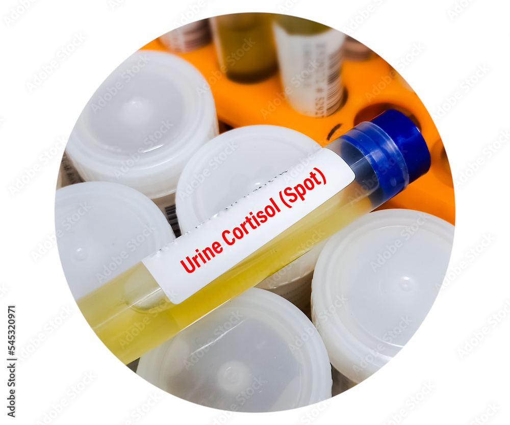 Sterile plastic container with urine sample for cortisol test at ...