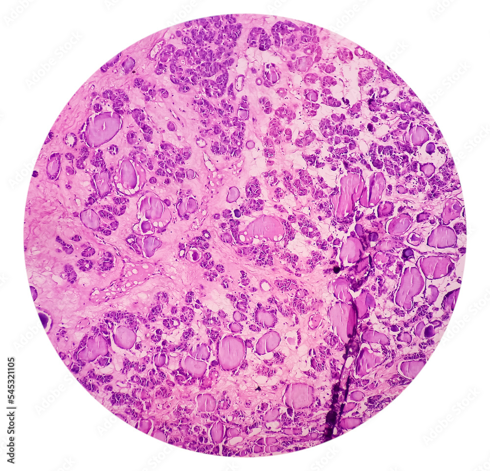 Follicular adenoma of thyroid gland, light micrograph. Histopathology ...