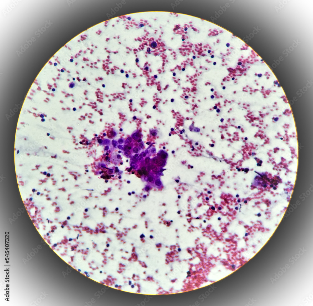 Intra abdominal mass(Cytology): Spindle cell sarcoma, positive ...