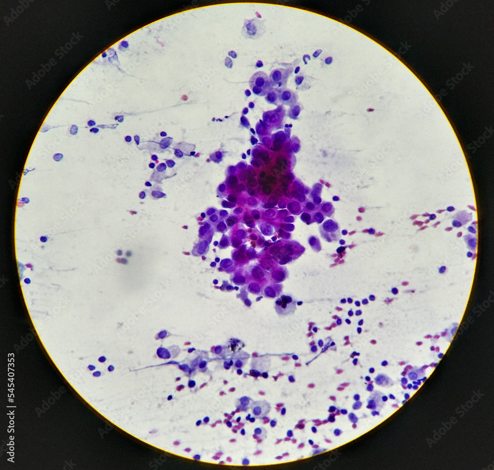 Intra abdominal mass(Cytology): Spindle cell sarcoma, positive ...