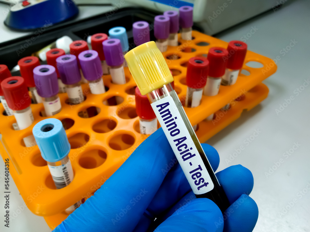 Blood sample for Amino acids profile test, Amino Acids Analysis. Stock ...