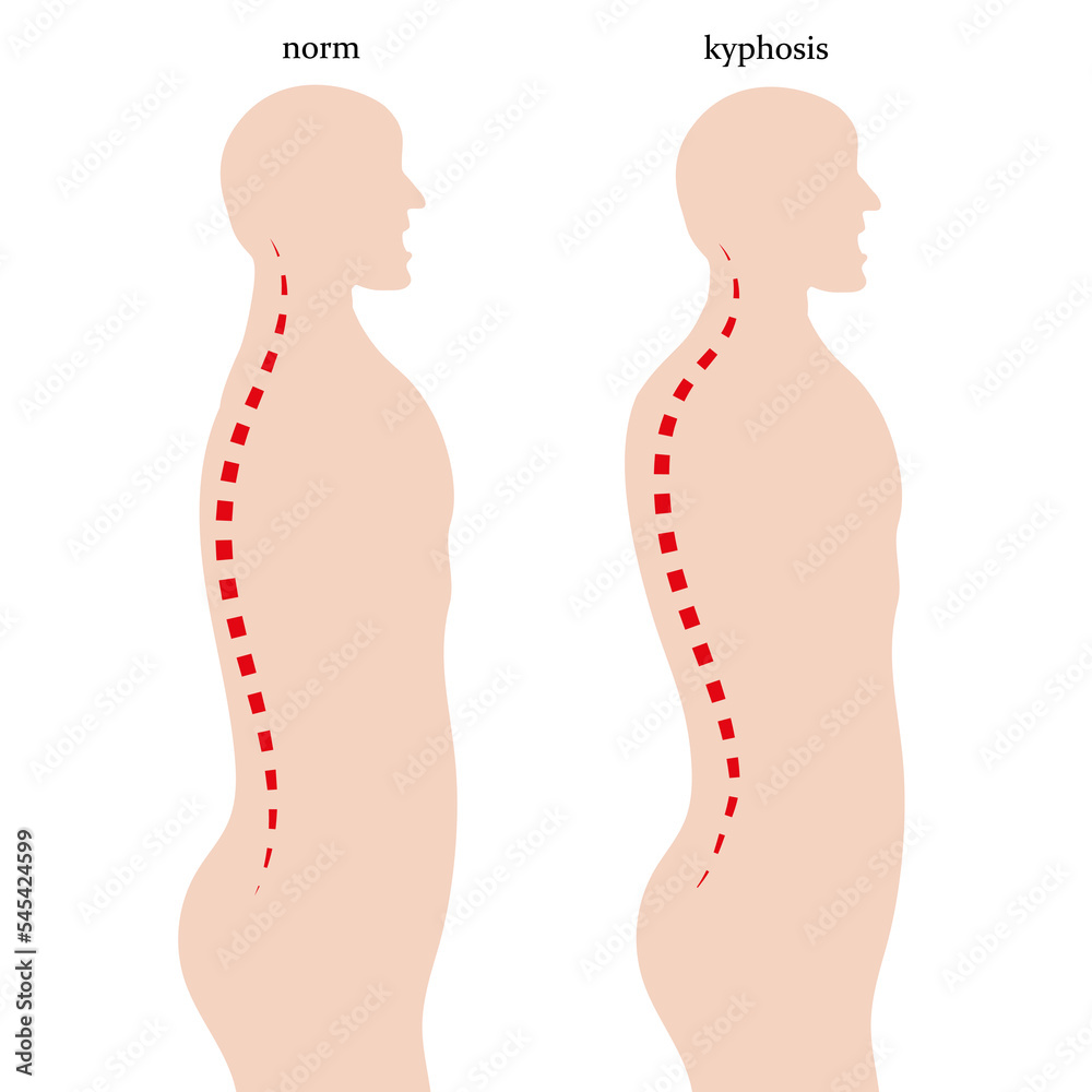Schematic representation of kyphosis, curvature of the spine. Vector ...