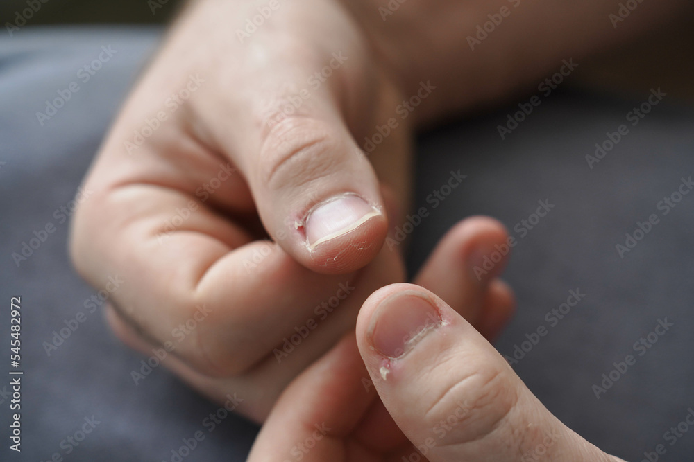 Men's manicure at home. Cut fingernails. Fingernails close-up ...