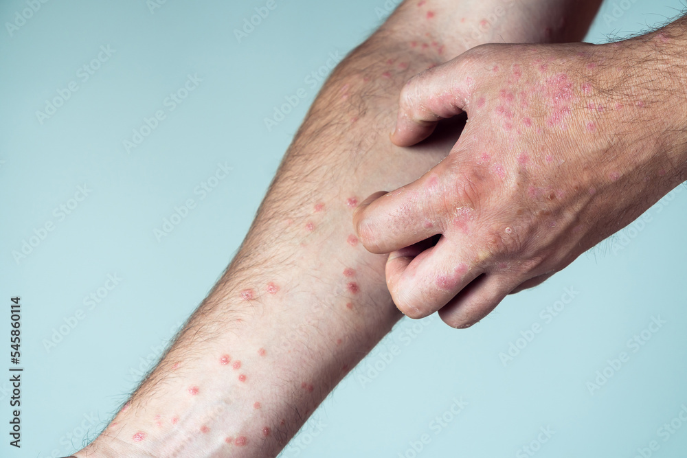 Cropped photo of man suffering from psoriasis scratching thick scaly ...