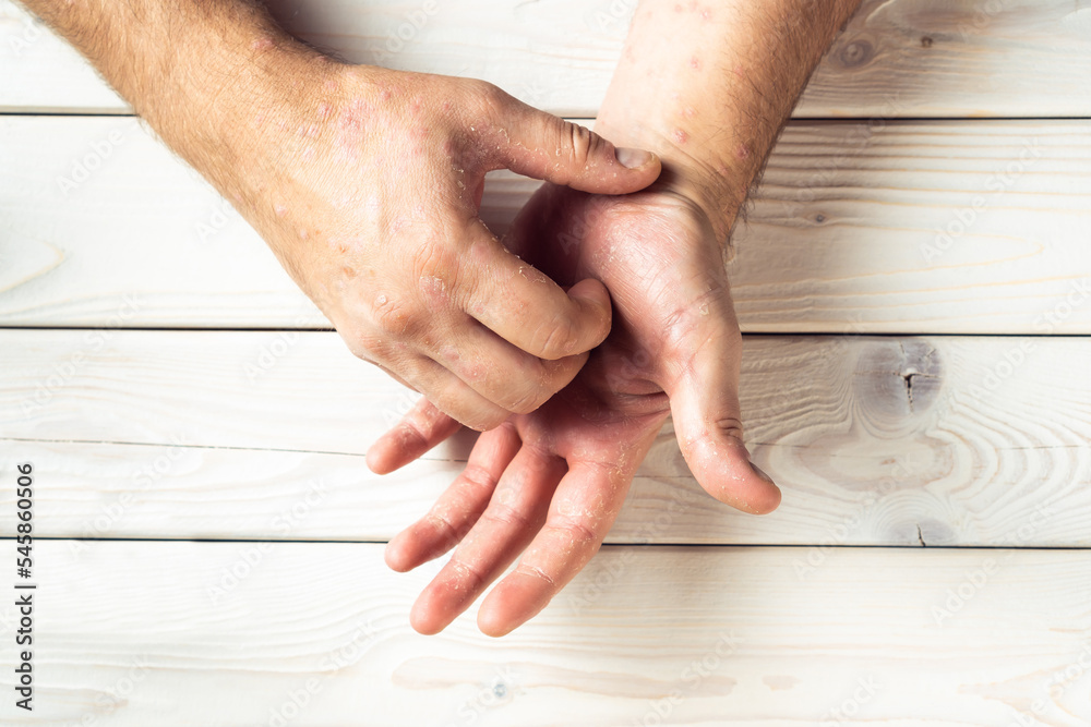 Poster Top view of unrecognizable man suffering from psoriasis ...