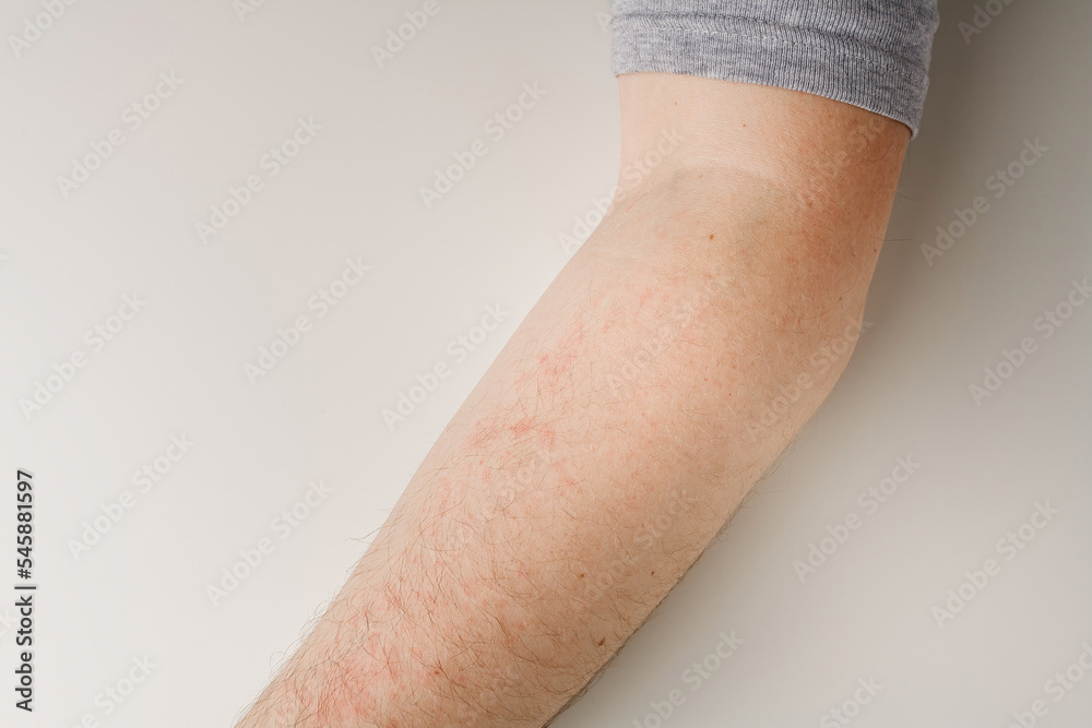 Foto de Male arm on white table with red spots on skin. Allergic ...