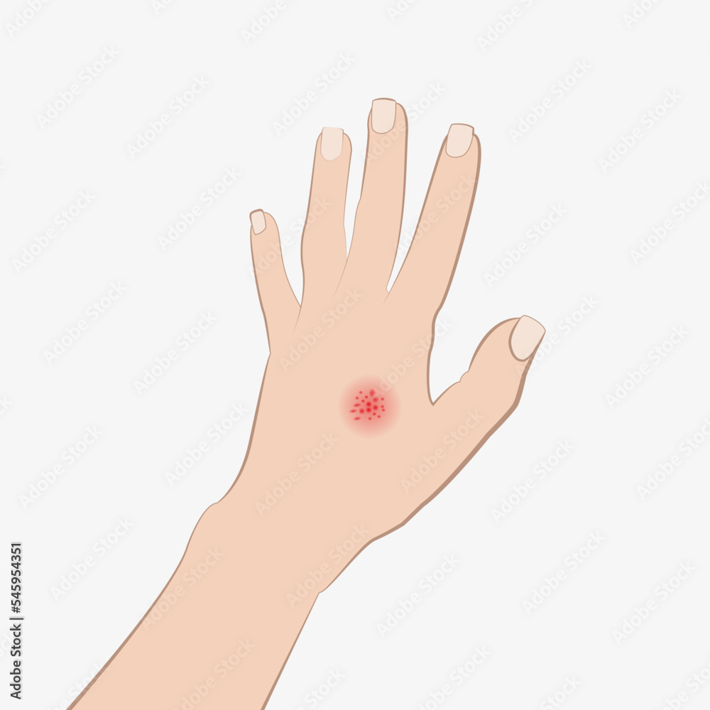 A woman's hand with an image of redness and rashes, signs of atopic ...