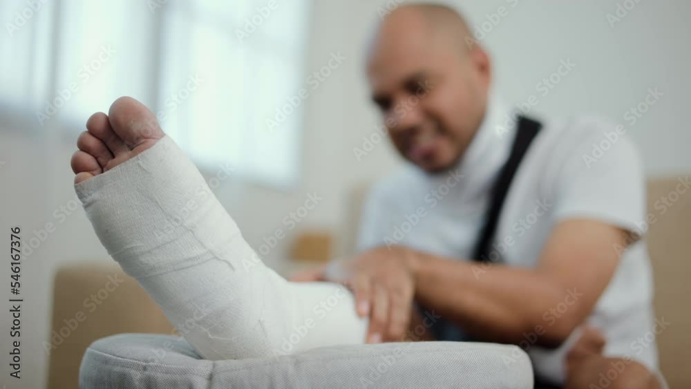 Vídeo do Stock: Close-up leg splints in cast of man suffered pain from ...