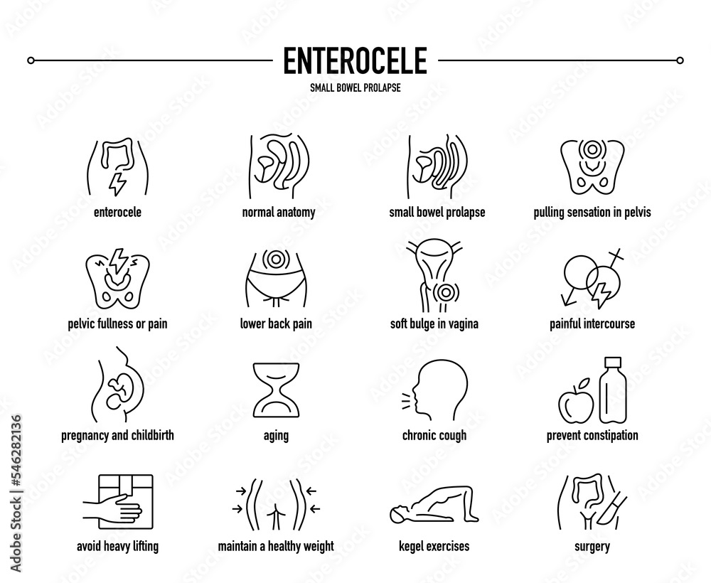 Photo & Art Print Enterocele, small bowel prolapse symptoms, diagnostic ...