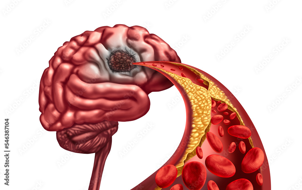 Vascular Dementia memory loss brain loss, Brain, Liquefactive Necrosis ... Vascular Dementia memory loss brain loss, Brain, Liquefactive Necrosis ...