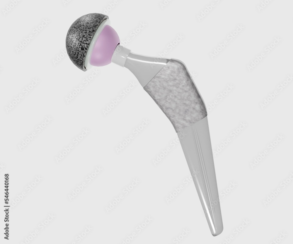 Total hip replacement components and examples of commercial hip stem ...